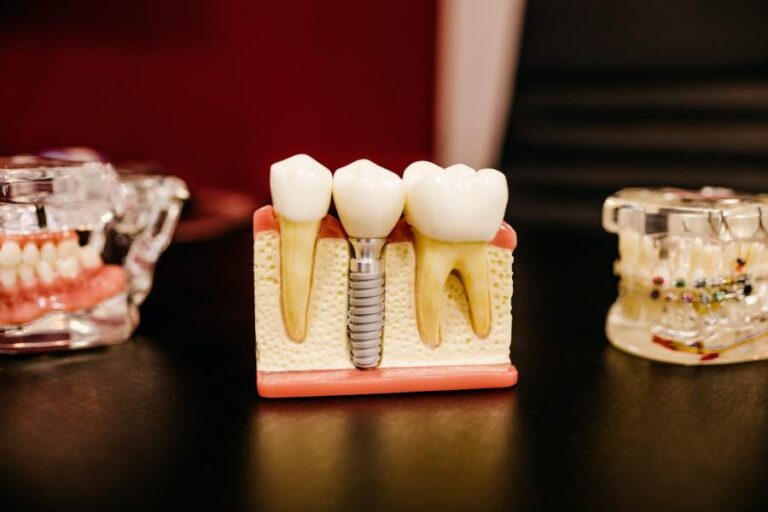 Combien coûte une dent sur pivot ? - Blog Santé & Bien-être