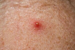 Boutons sur le pénis : quelles en sont les causes et comment les ...